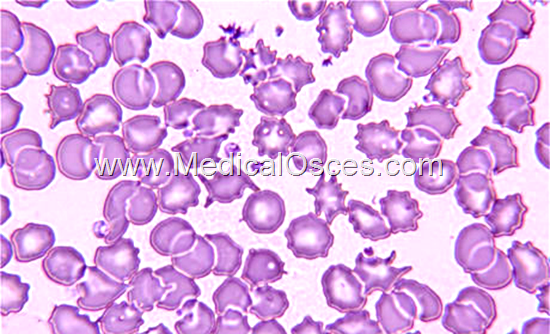 Identify erythrocyte abnormalities ? ~ Medical OSCES